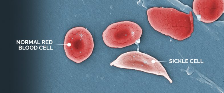 Can Gene Therapy Cure Sickle Cell Disease?